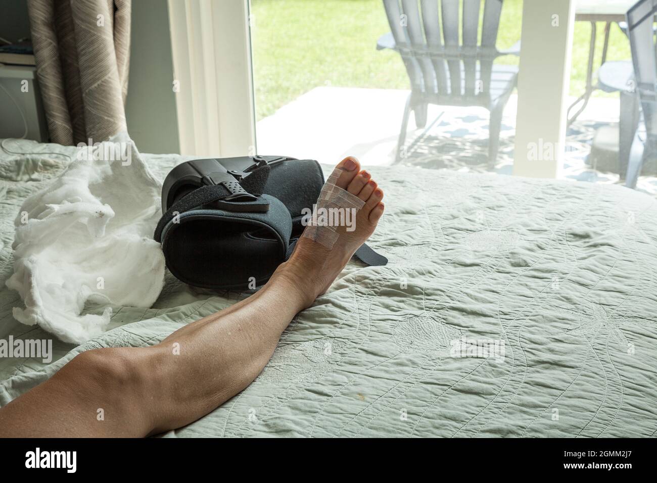 Cast removed from a foot after bunion surgery as the leg is elevated ...