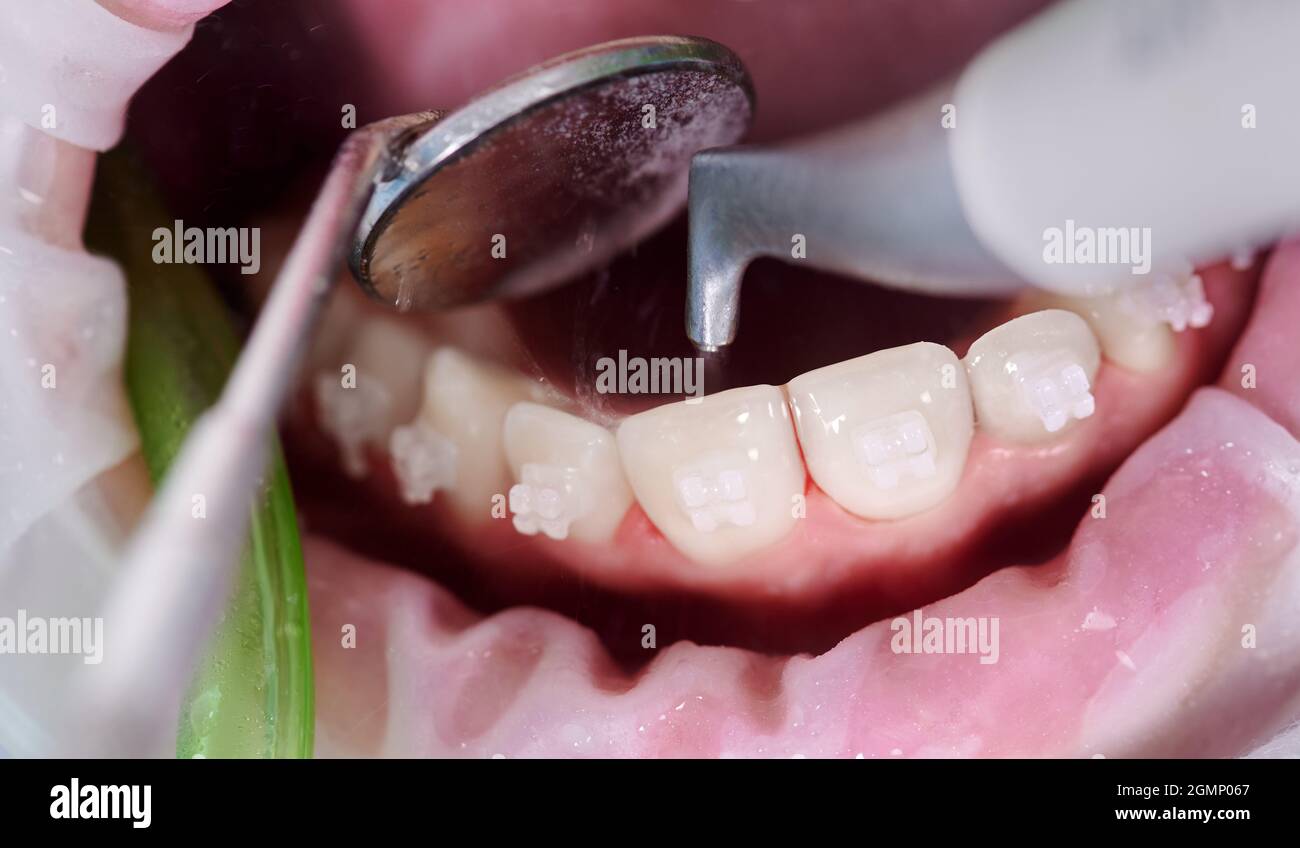 Macro photography. Cleaning process in patient's mouth with cheek ...