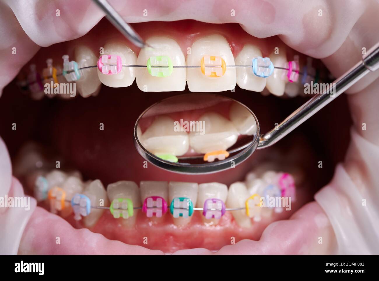 Close up of dentist checking patient brackets on teeth with dental ...