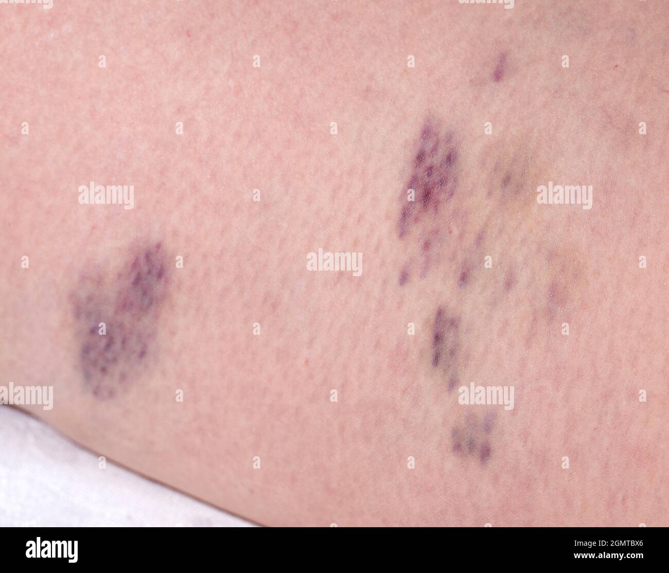 Bruises On The Legs High Resolution Stock Photography and Images - Alamy