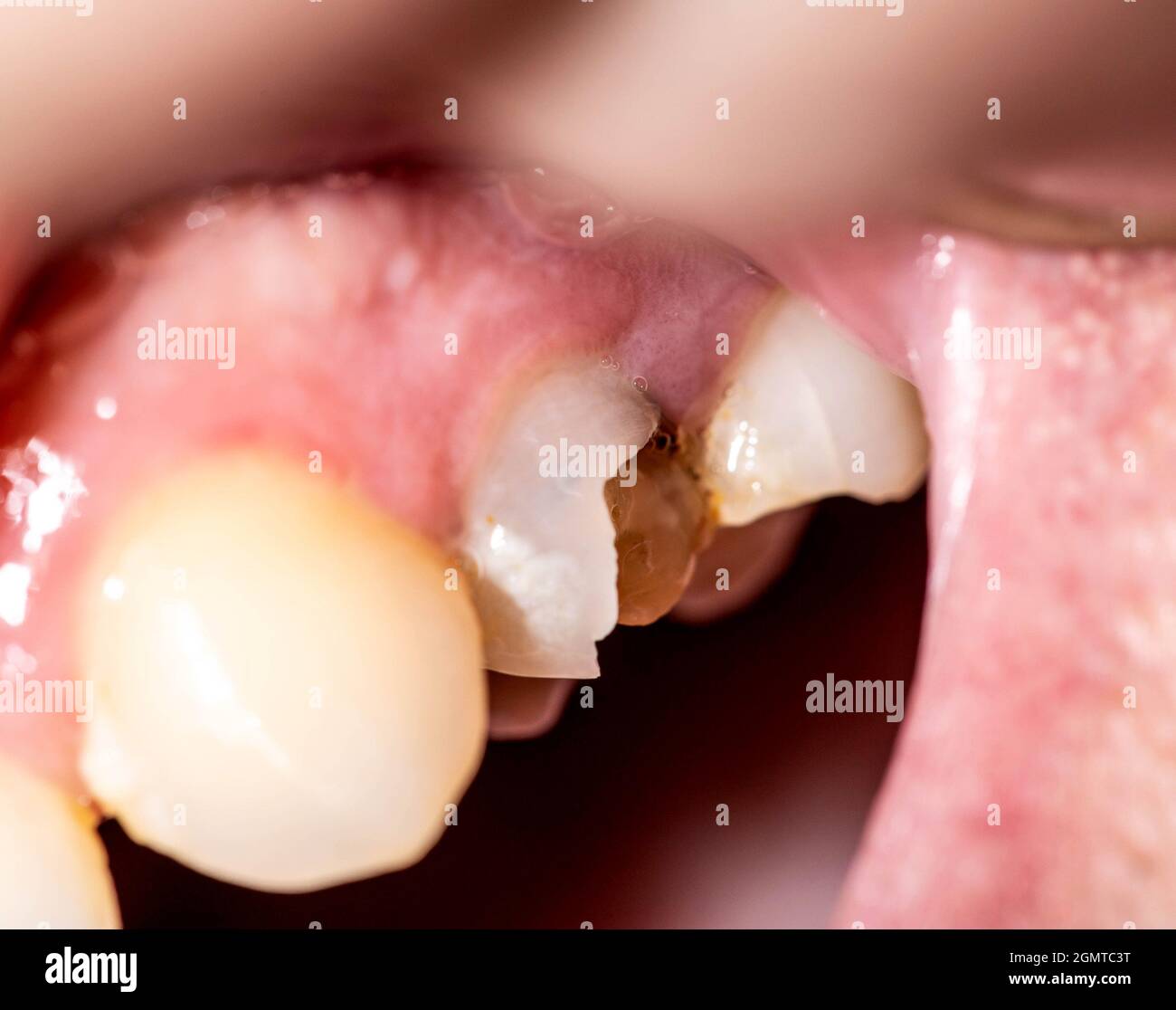 A black dead tooth in which a piece of tooth enamel is chipped off, a ...