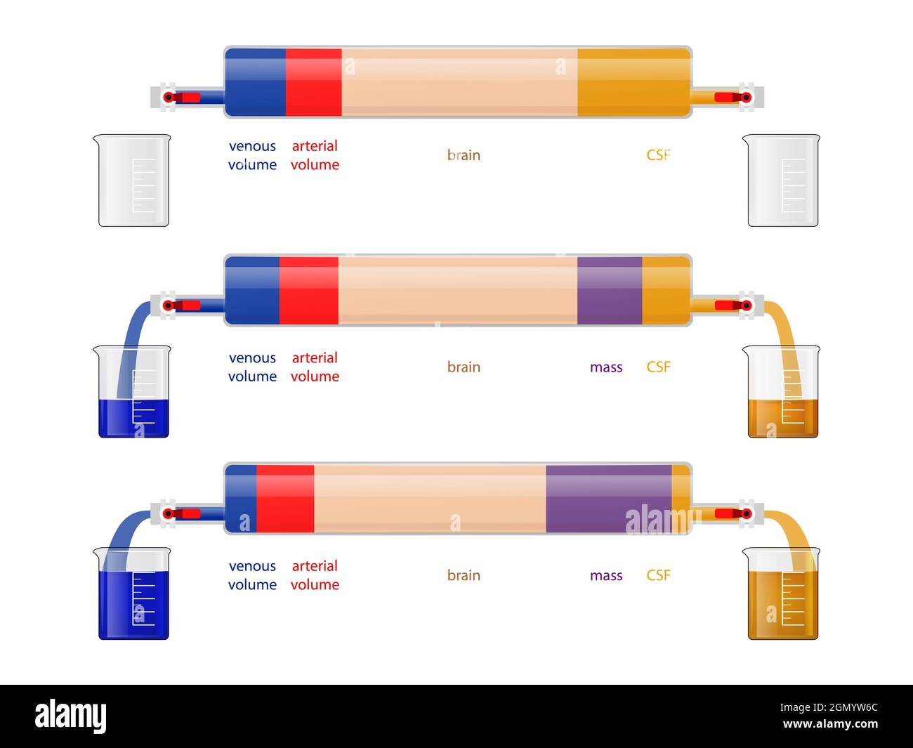 intracranial pressure and cerebral haemodynamics, The Monro-Kellie ...