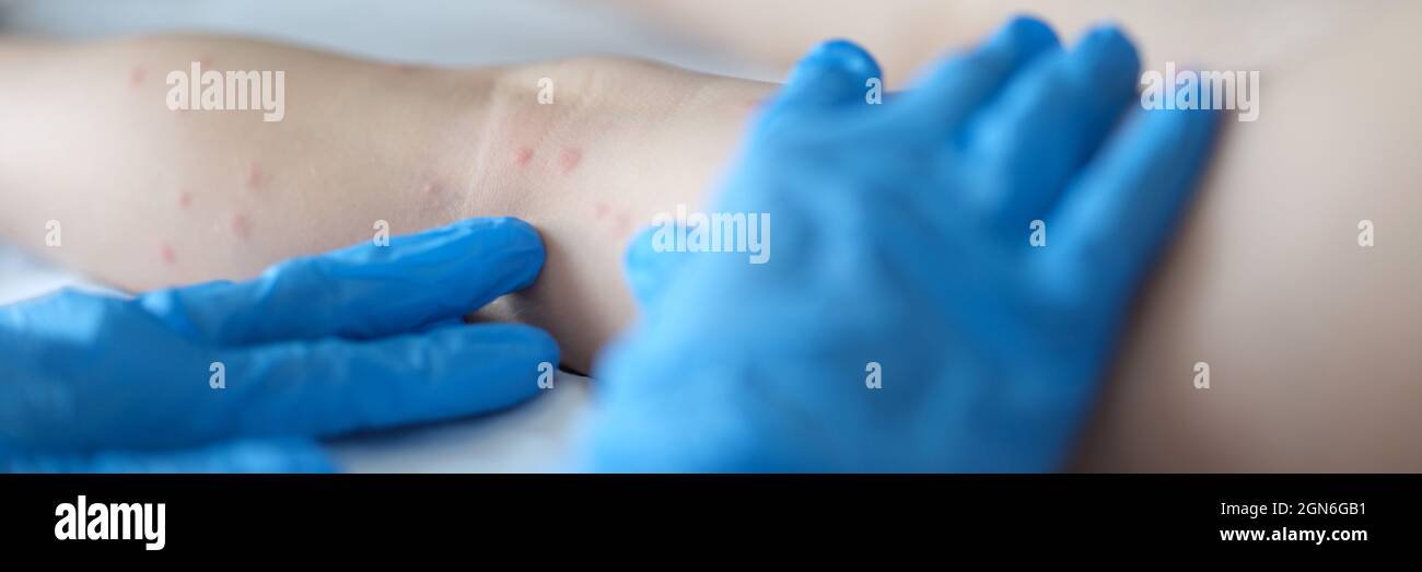 Doctor examining red rash on legs of child in clinic closeup Stock ...