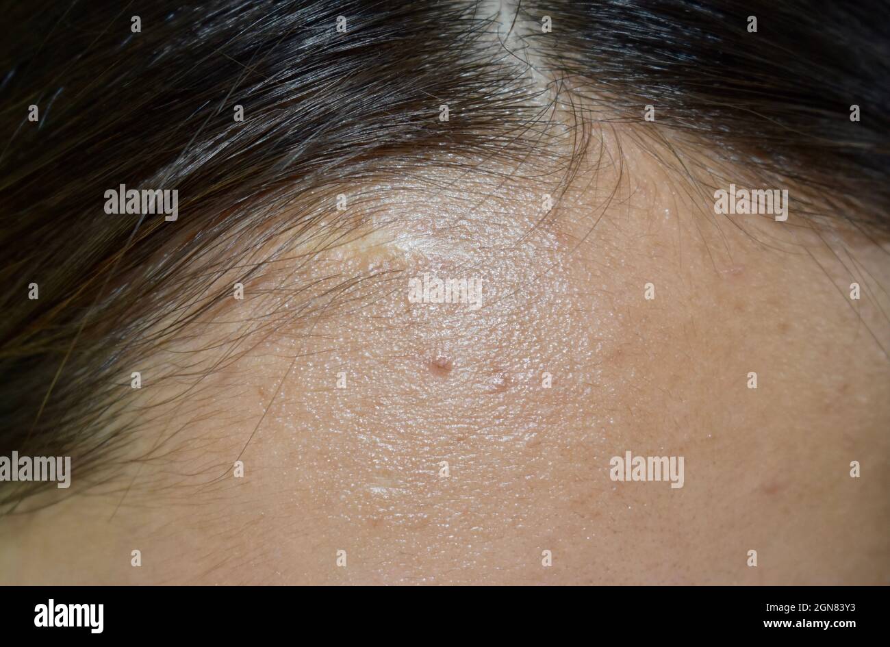 Oily skin with wide forehead of Southeast Asian, Myanmar or Korean ...