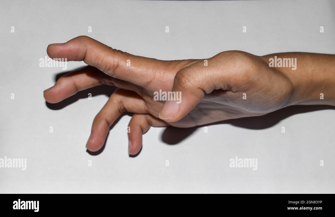 Volkmann’s contracture in upper limb of Asian young woman. It is a ...