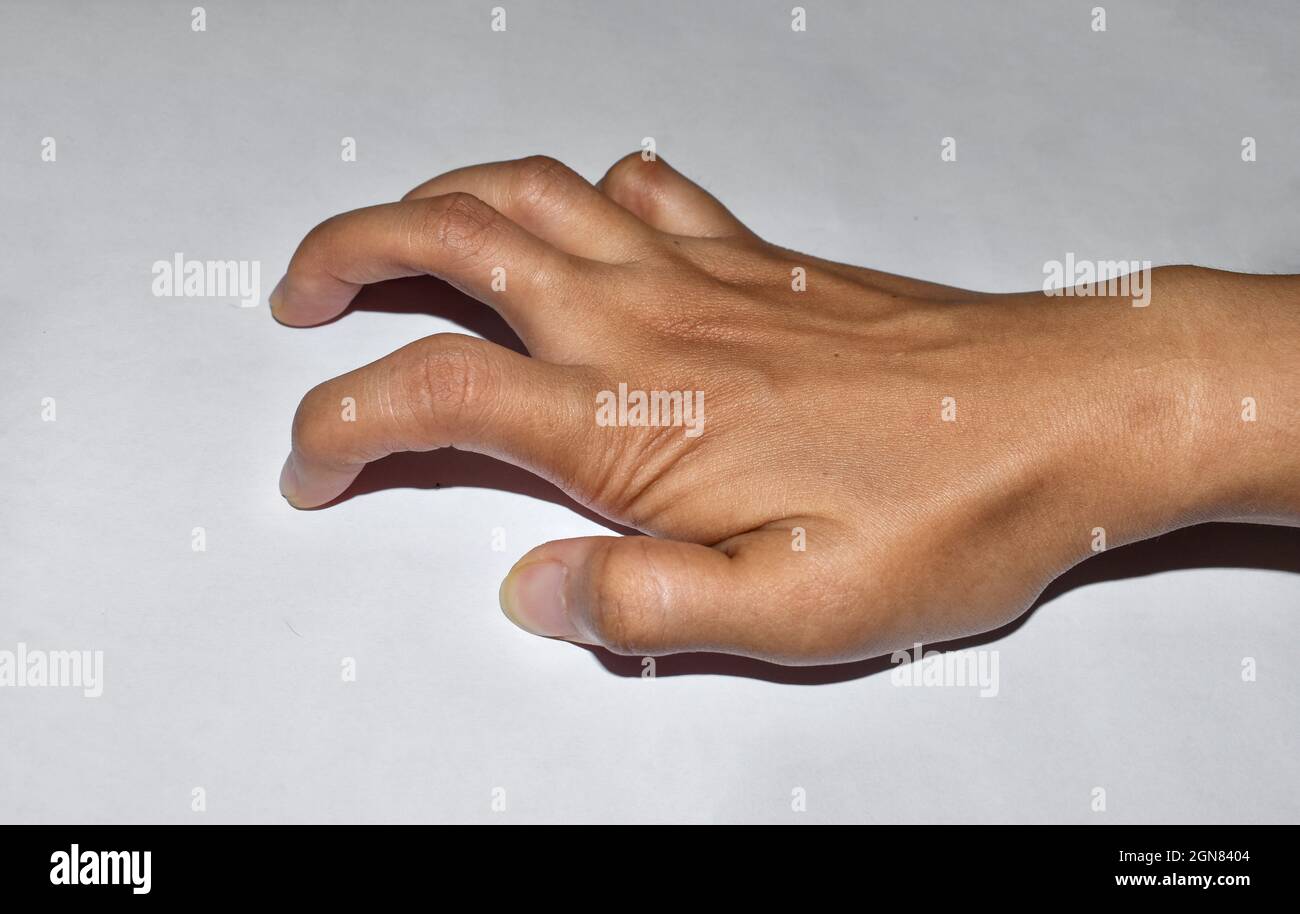 Volkmann’s contracture in upper limb of Asian young woman. It is a ...