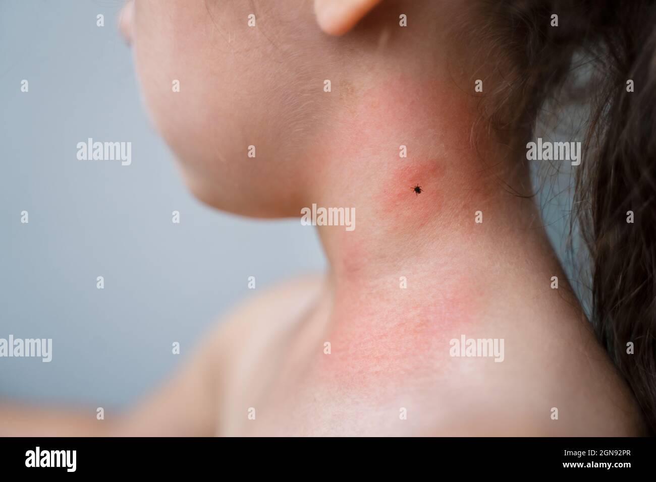 Encephalitis Mite Bug Or Arachnid Parasite Under Child Skin Stock Photo ...