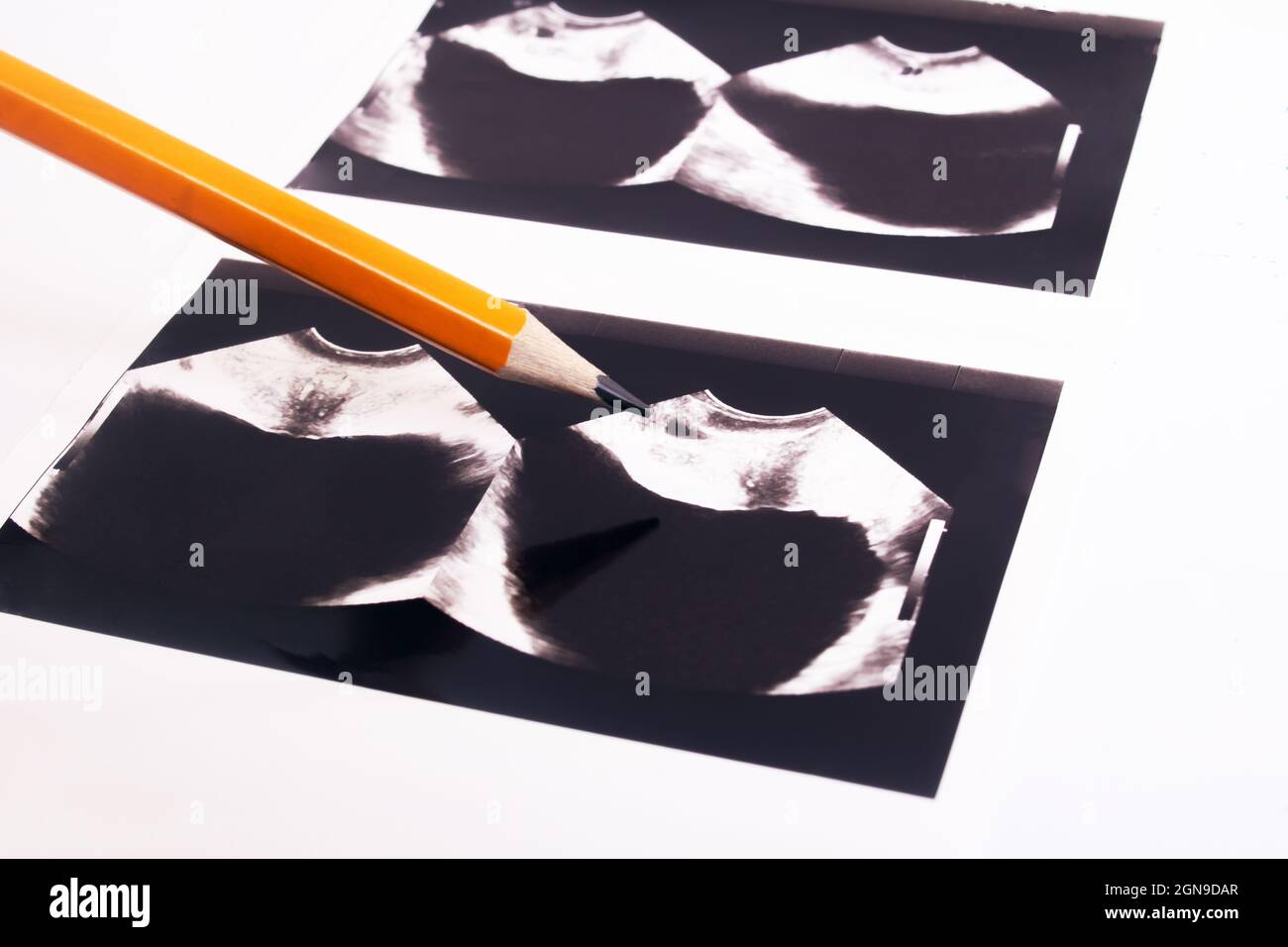 Image of an ultrasound scan of the prostate close up Stock Photo - Alamy
