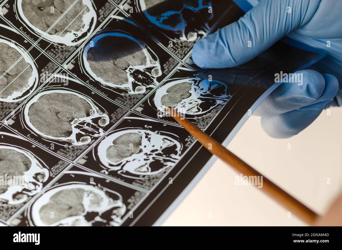 Neurosurgeon performs analysis of CAT Scans showing the human he Stock ...