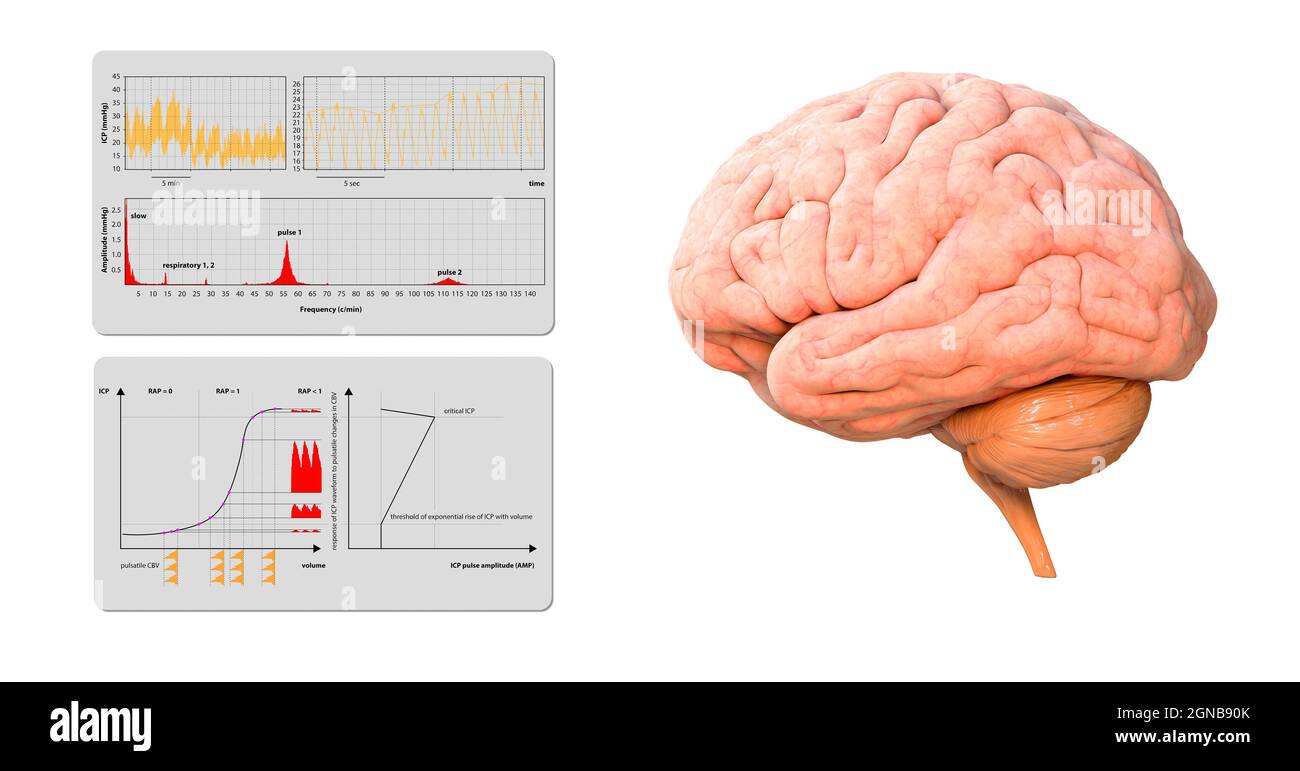 Intracranial Pressure Monitoring ICP waveform, 3d render, 2d graphic ...