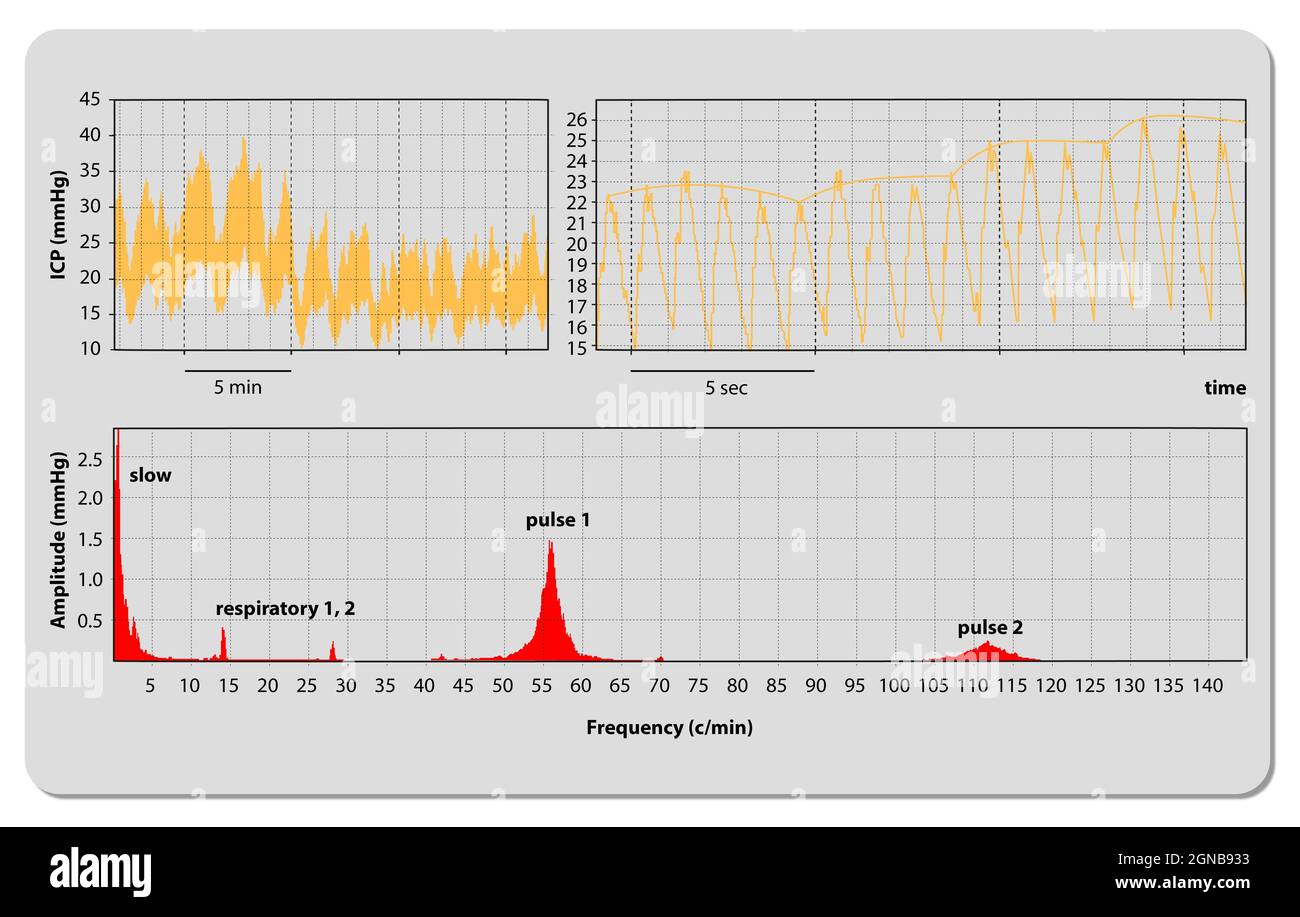 Intracranial Pressure Monitoring ICP waveform, 3d render, 2d graphic ...