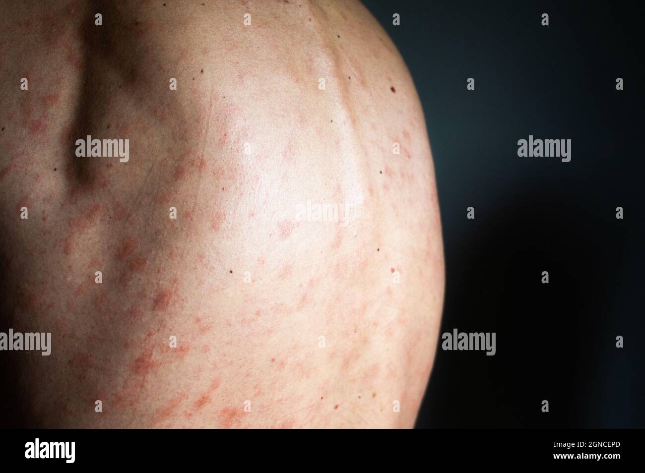 Allergy concept. Man suffers from skin irritation isolated on gray ...