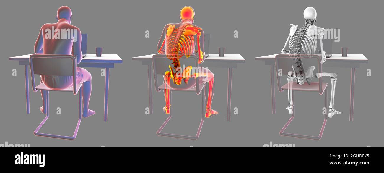 Bad posture whilst using laptop, illustration Stock Photo - Alamy