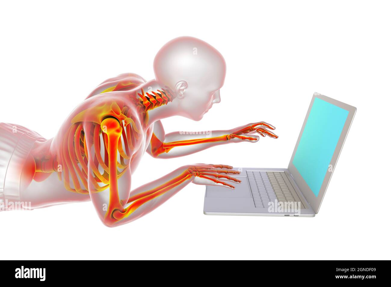 Bad posture whilst using laptop, illustration Stock Photo - Alamy