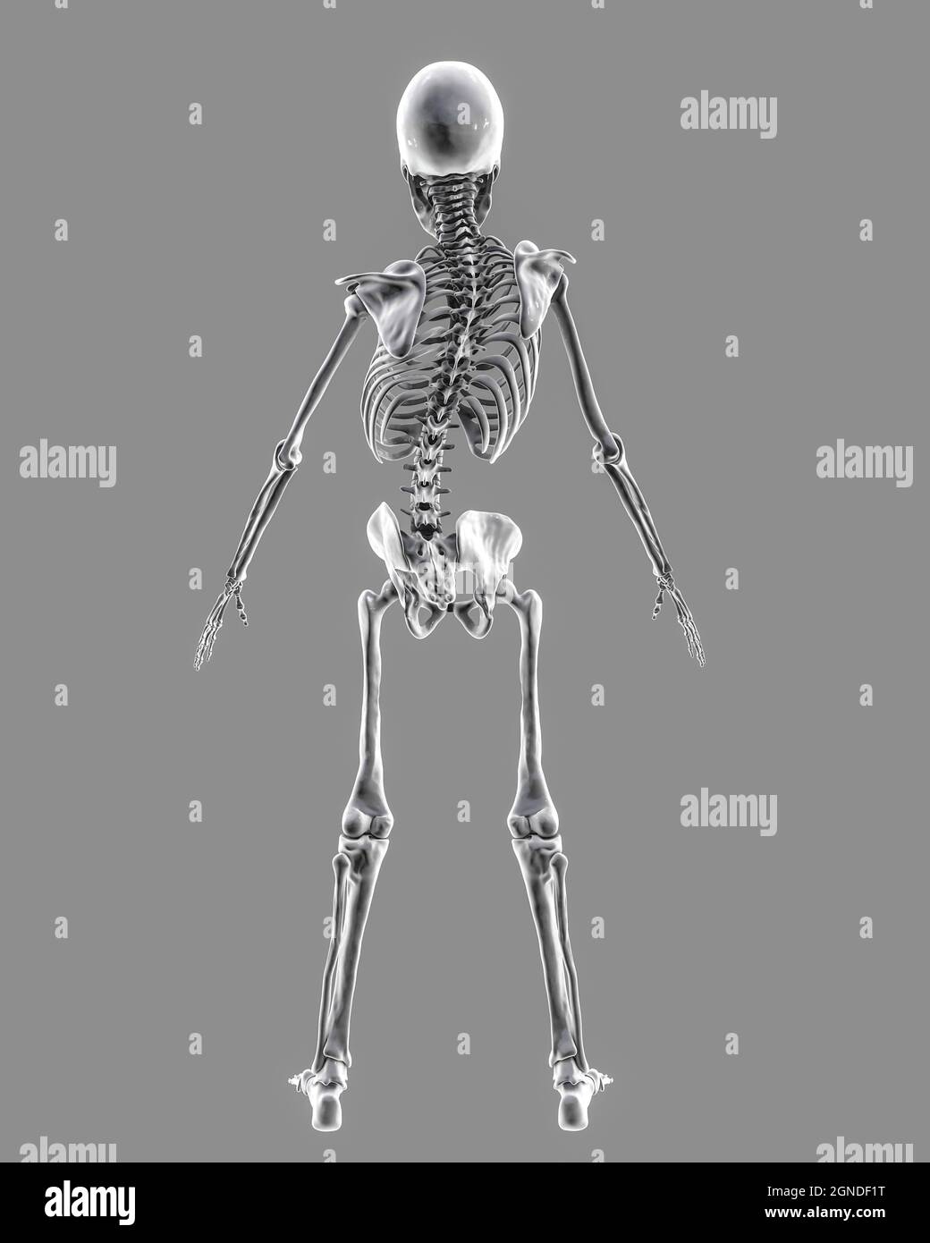 Severe Scoliosis Skeleton