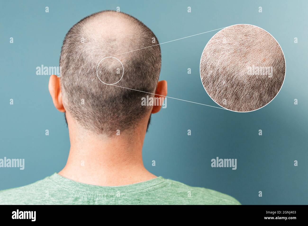 Back view of baldness man. Zoomed area of bald spot. Rear view. Blue ...
