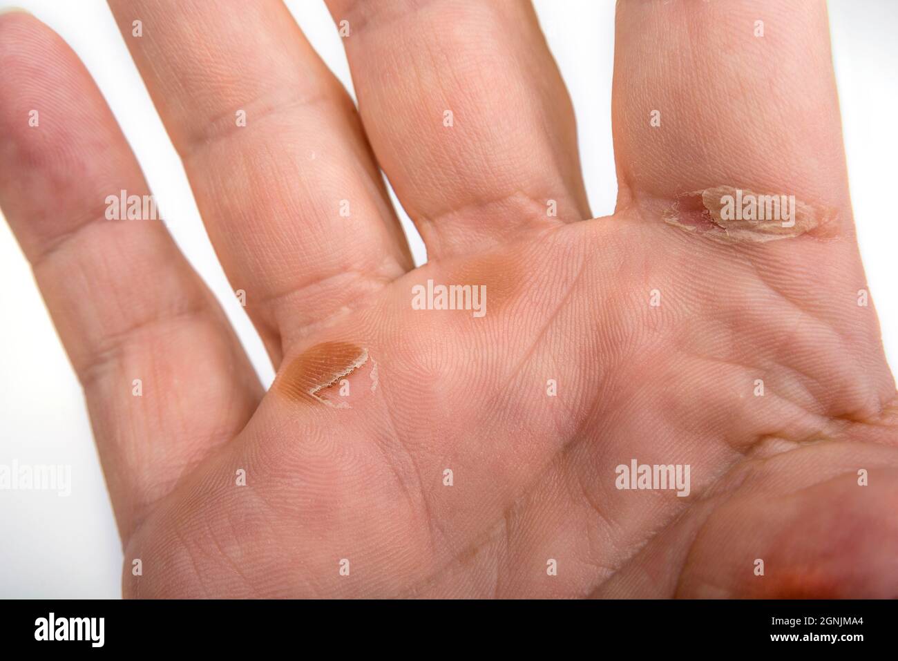 Hand Callus Pictures at Frank Keith blog