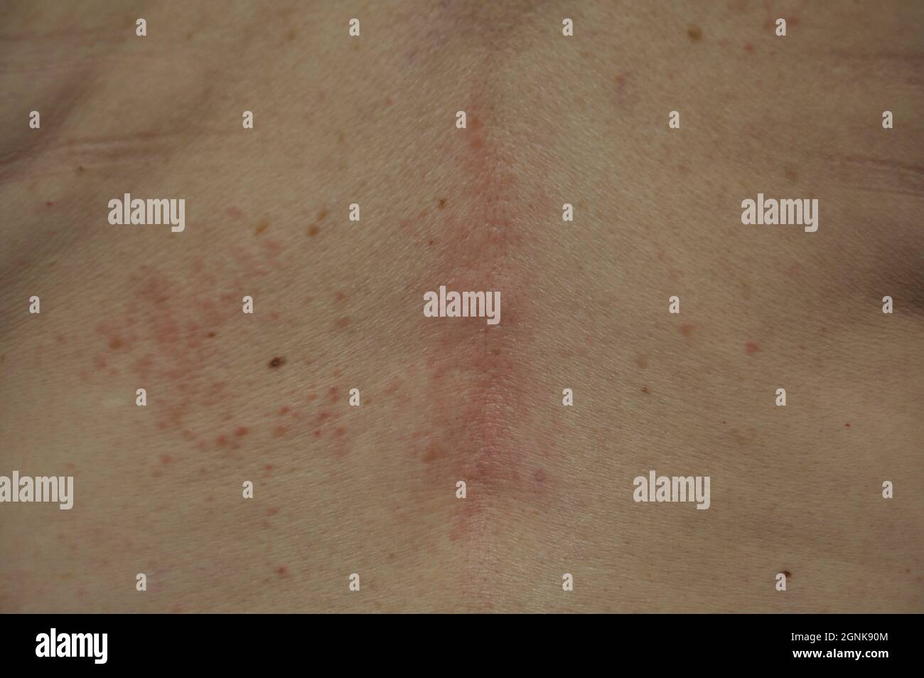 Eczema pimples on a back Stock Photo - Alamy