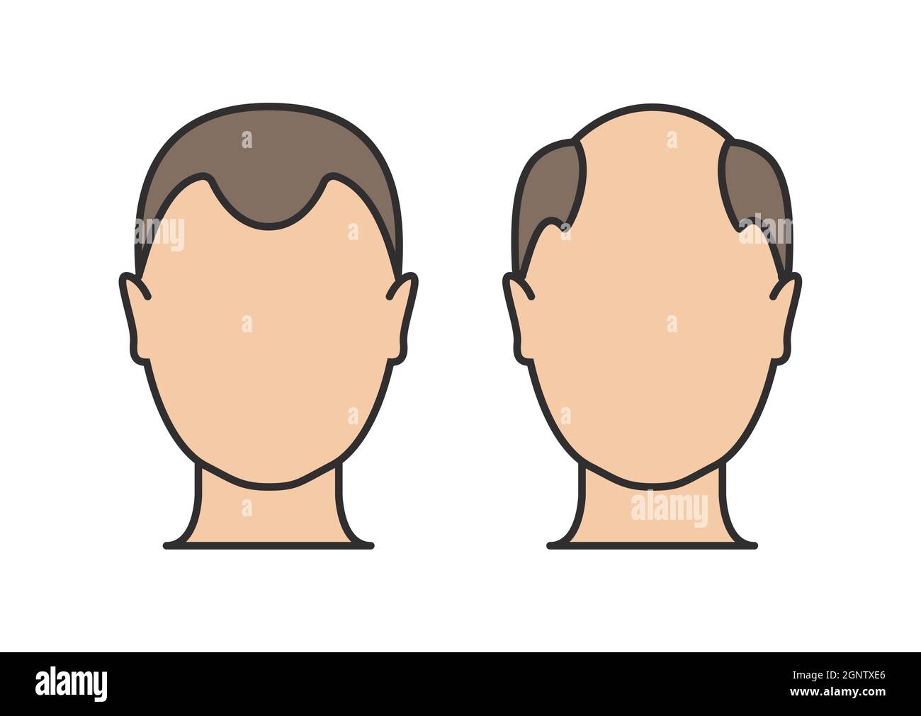 Hair loss man icon cartoon vector logo. Hair loss male scalp bald ...