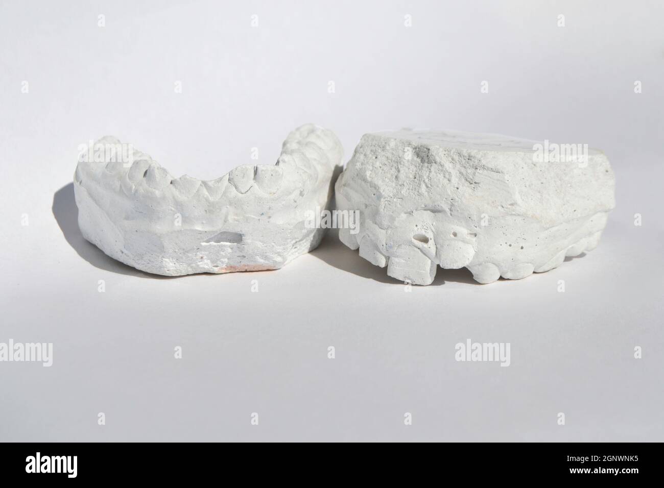 Gypsum Model Dental at Audrey Begay blog