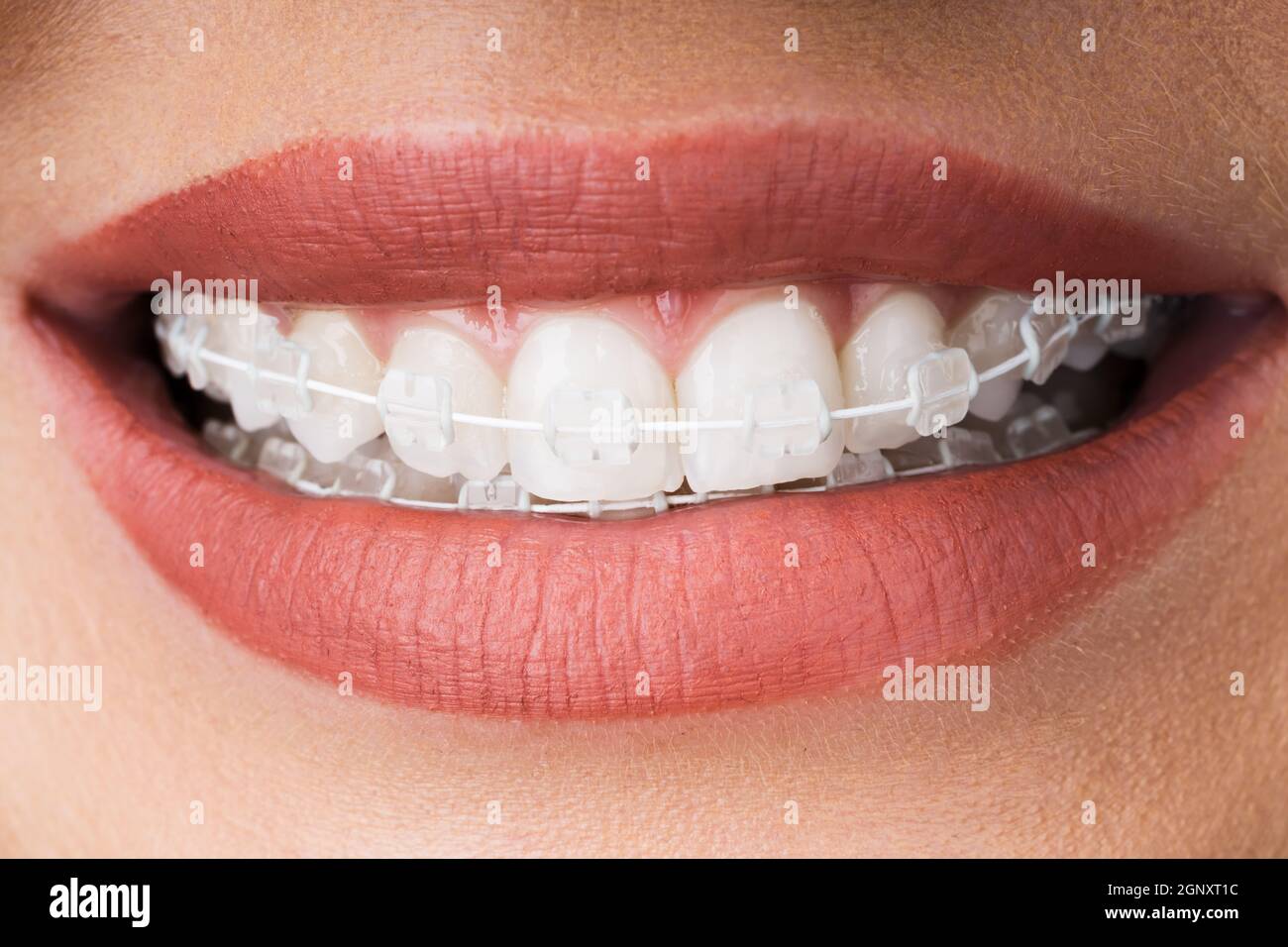 White Bracket Braces