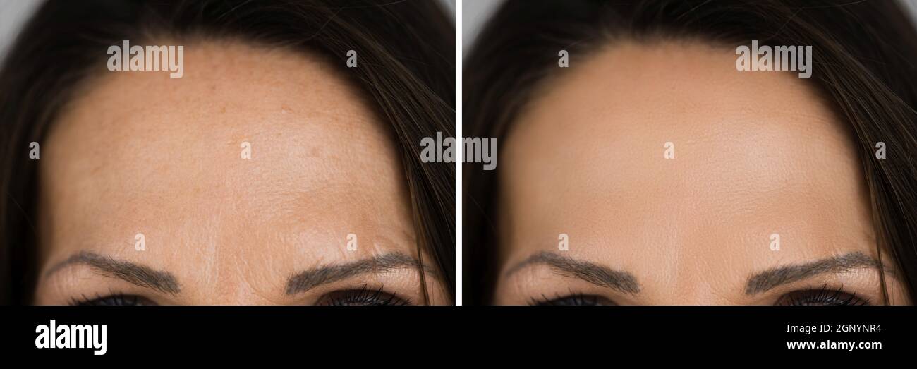 Anti Rejuvenation Forehead Wrinkles Lift Before And After Stock Photo ...