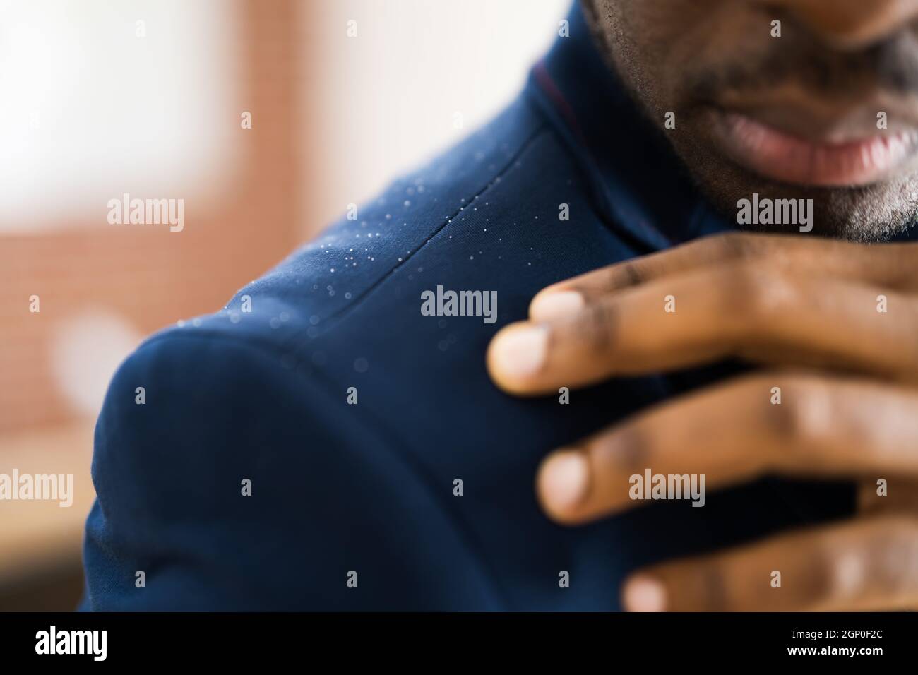 Man itchy hair hi-res stock photography and images - Alamy