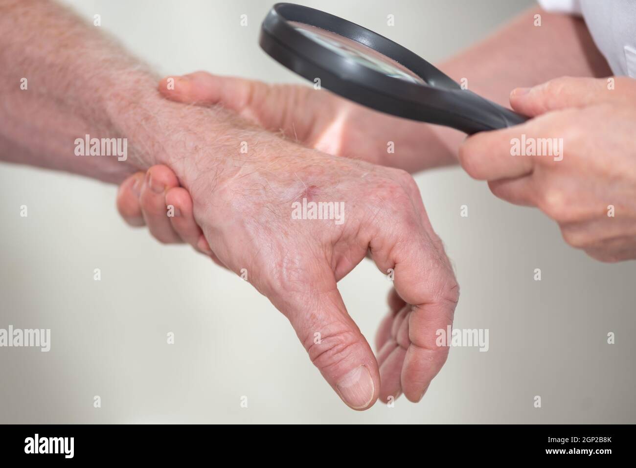 Dermatologist examining skin of patient hand with magnifying glass ...
