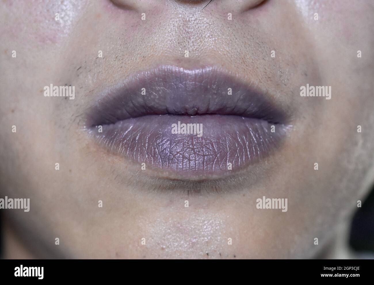 Central cyanosis hi-res stock photography and images - Alamy