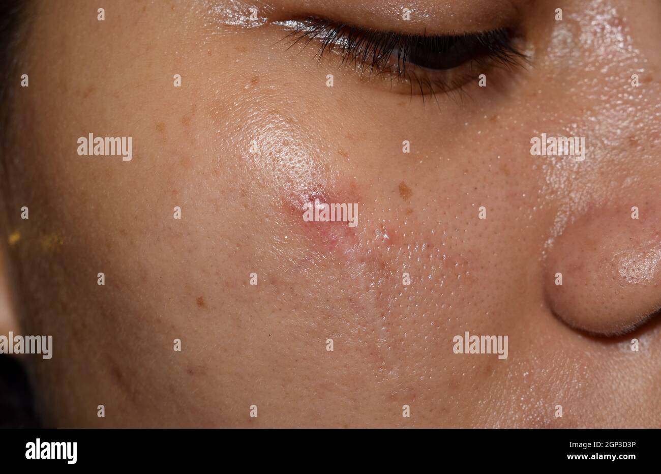 Cyst acne hi-res stock photography and images - Alamy