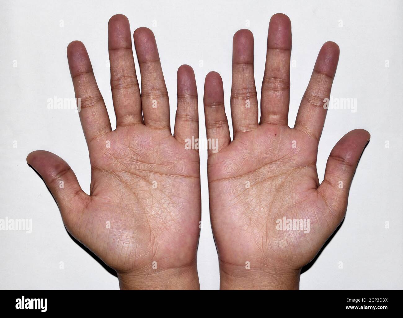 Cyanosis skin color hi-res stock photography and images - Alamy