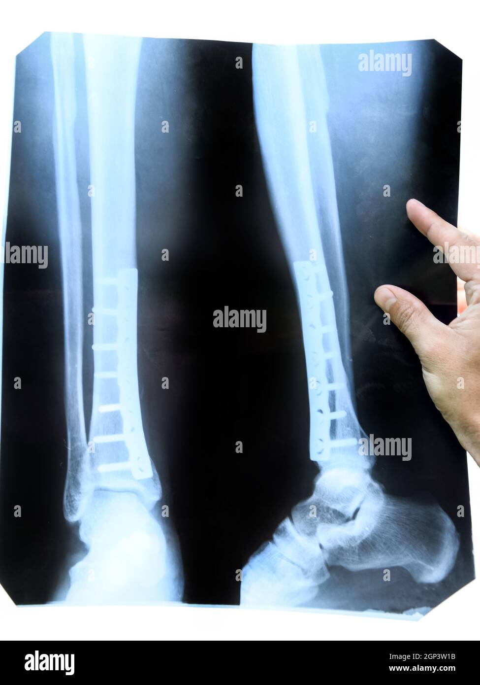 Tibia Fibula X Ray High Resolution Stock Photography and Images - Alamy