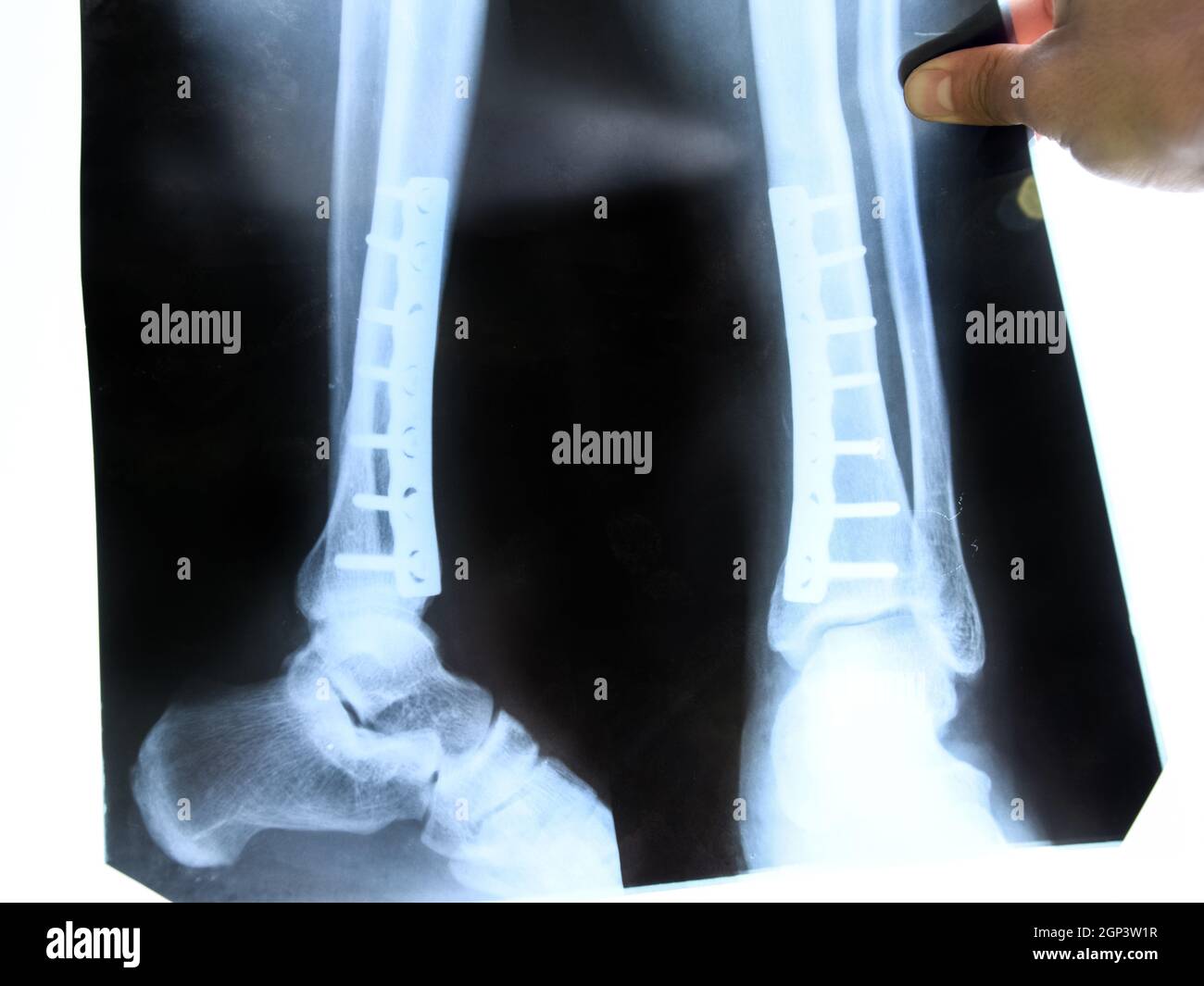 Tibia Fibula X Ray High Resolution Stock Photography and Images - Alamy