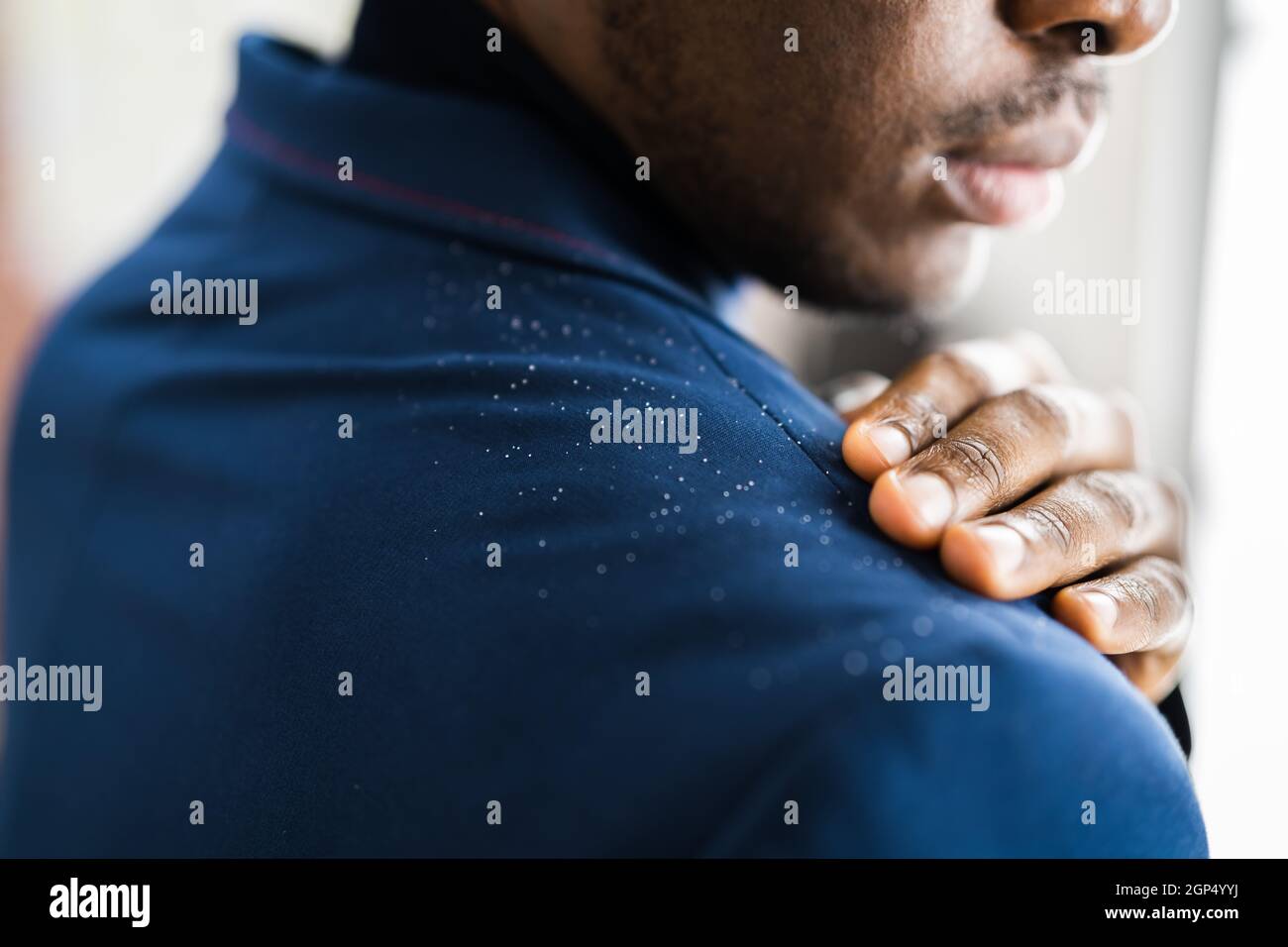 Man itchy hair hi-res stock photography and images - Alamy