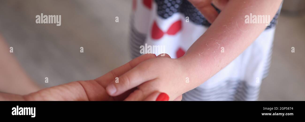 Sunburn redness and peeling of skin on child hand closeup Stock Photo ...