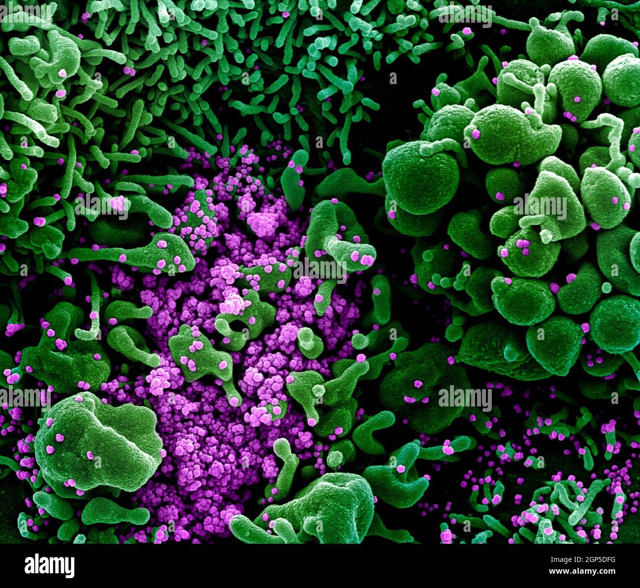 Apoptotic cell (green) heavily infected with SARS-COV-2 virus particles ...
