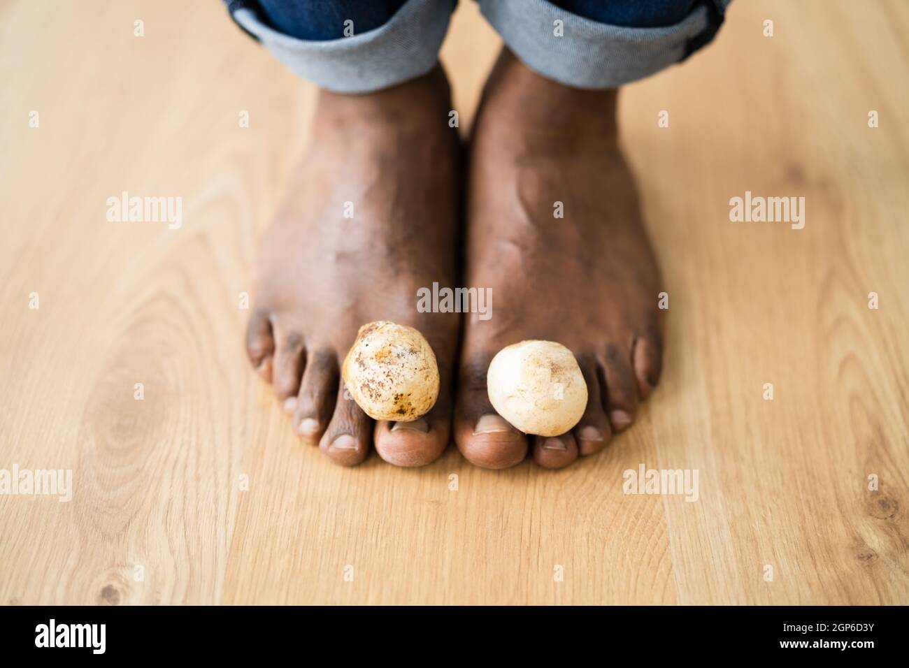 Feet Fungus Mushroom Between Toenail. Foot Fungi Stock Photo - Alamy