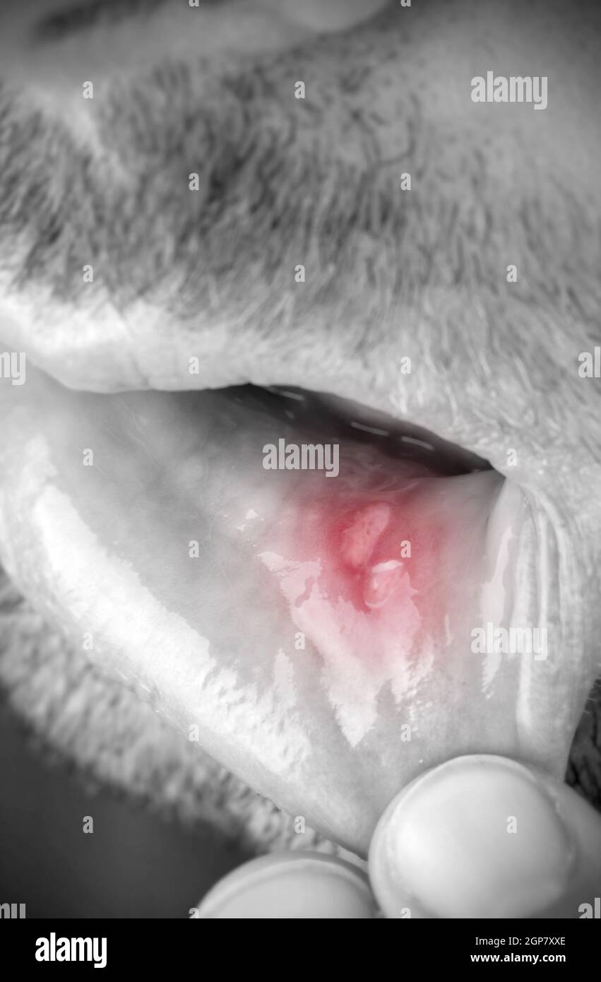 Man shows his lower lip of the mouth with aphtha Stock Photo - Alamy