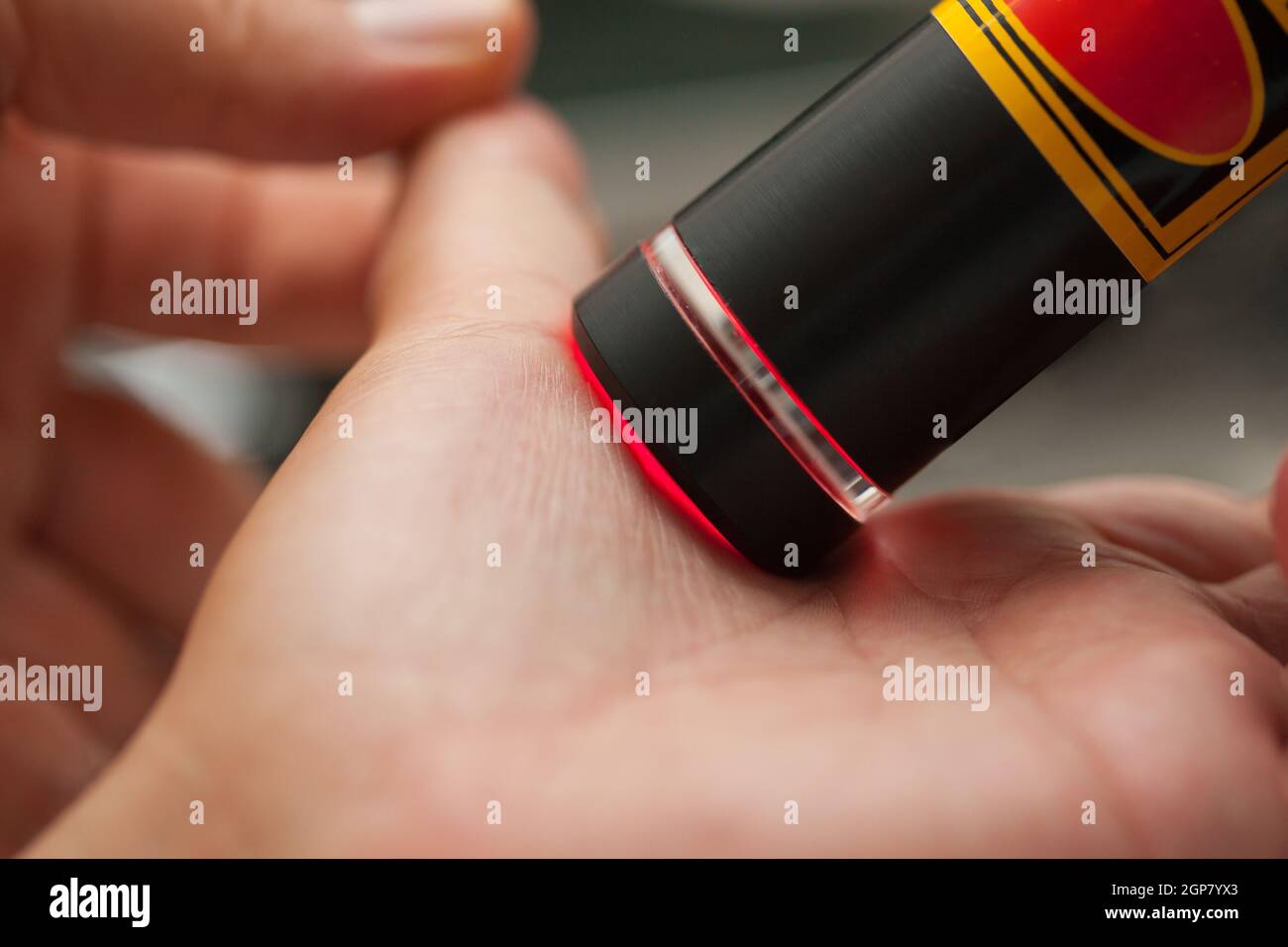 Treatment Laser therapy to the articulation of the thumb Stock Photo ...