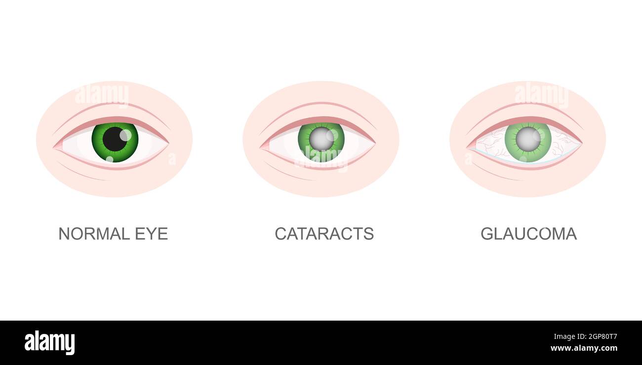Healthy, cataract and glaucoma eye closeup view. Eyeball with normal ...