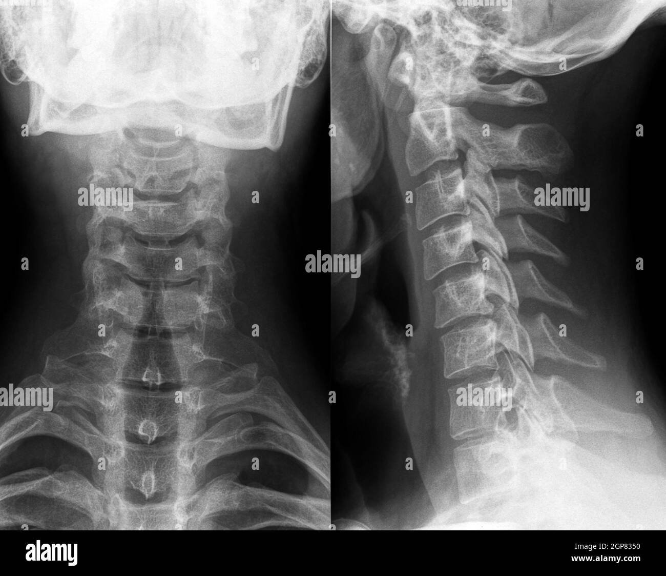 Xray of neck and cervical spine, front and side view Stock Photo - Alamy