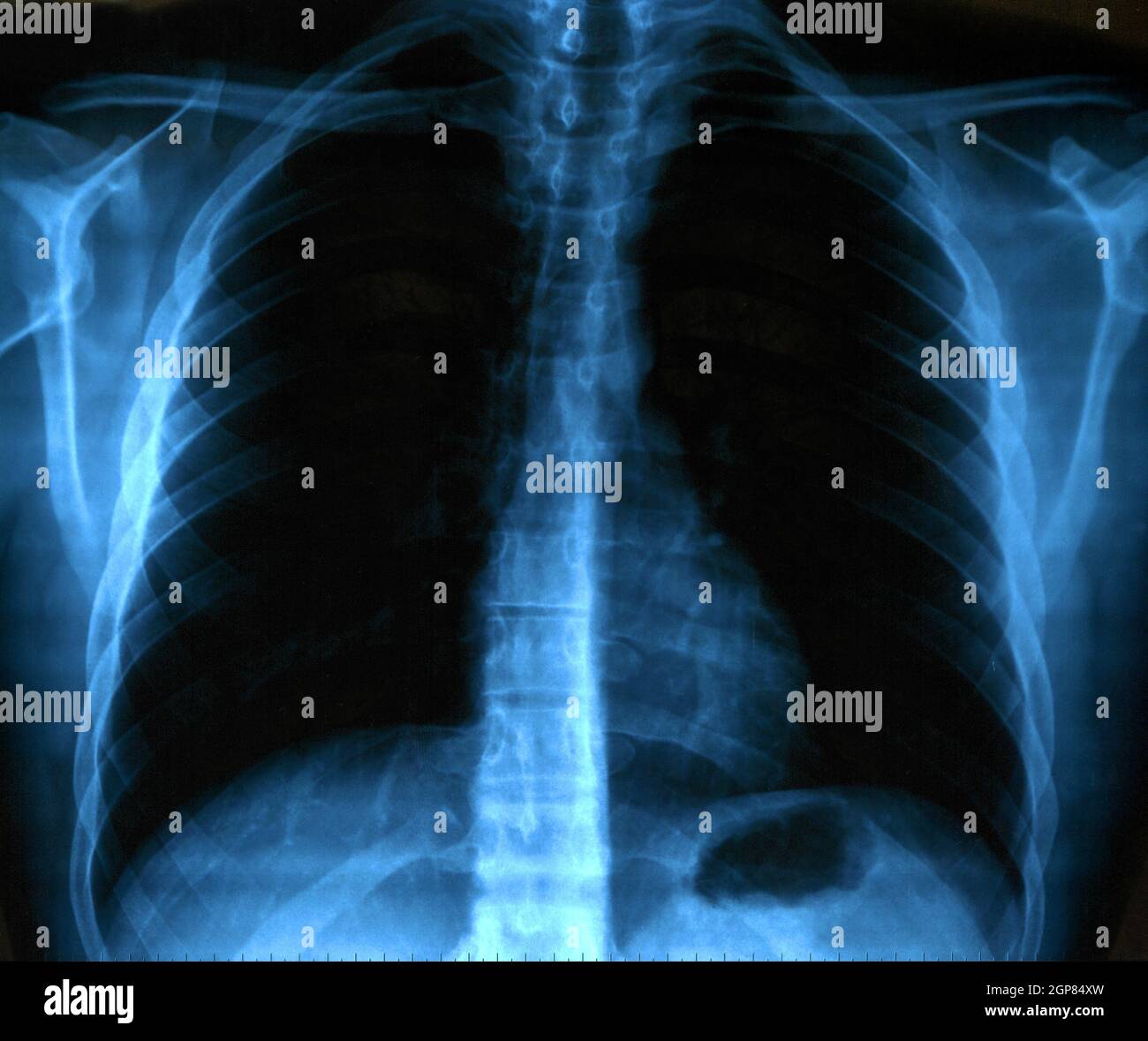 X Ray Image Of Human Healthy Chest Stock Photo - Alamy