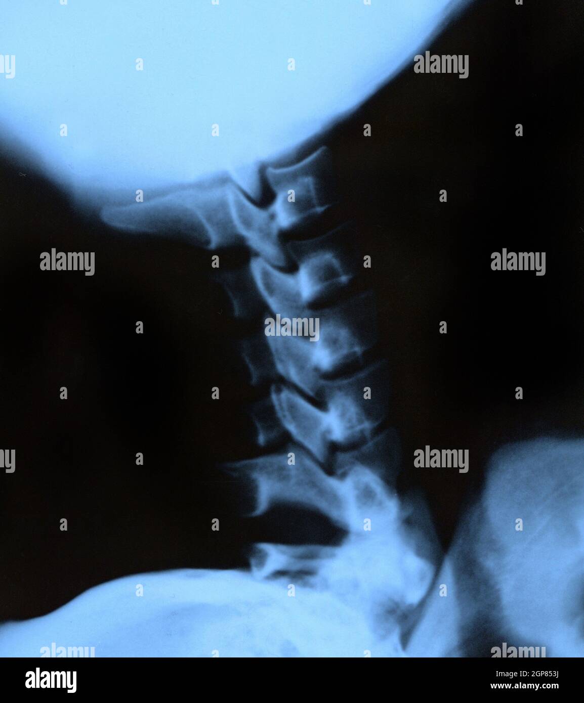 Neck x ray of cervical vertebrae hi-res stock photography and images ...