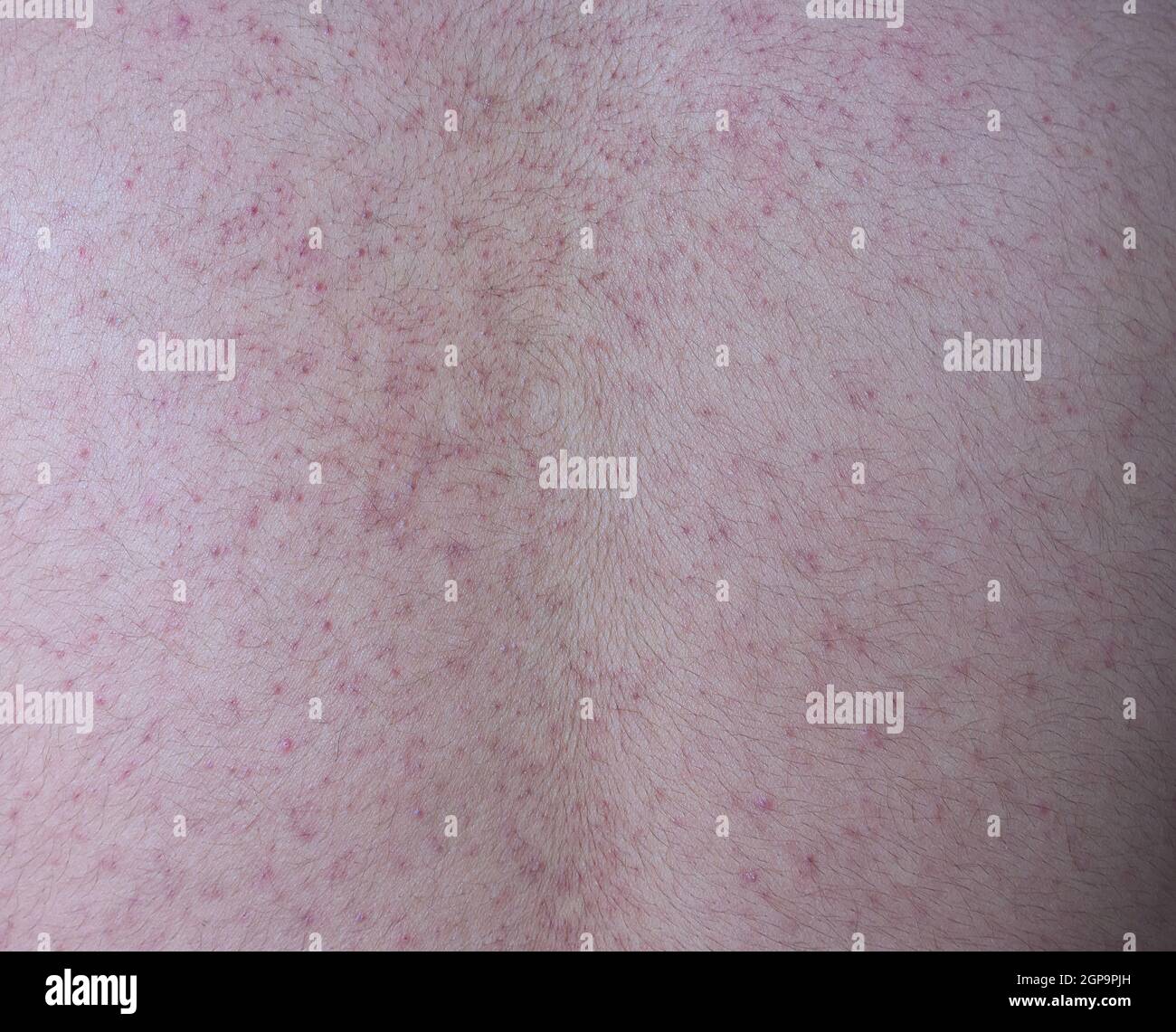 Background of human skin with allergic red spots. Eczema atopic dermatitis symptom skin on back ...