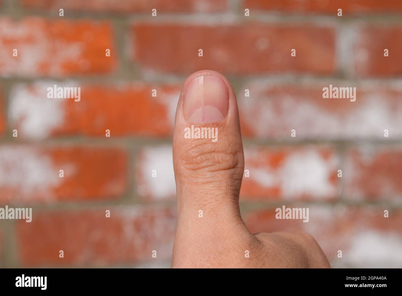 Forked nail on the thumb. Dilation of the nail, traumatic pathology ...