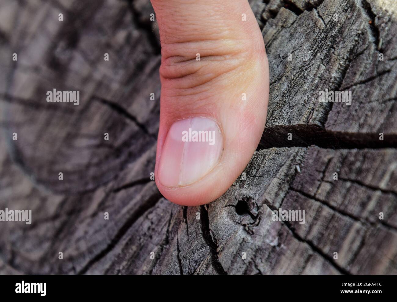 Forked nail on the thumb. Dilation of the nail, traumatic pathology ...