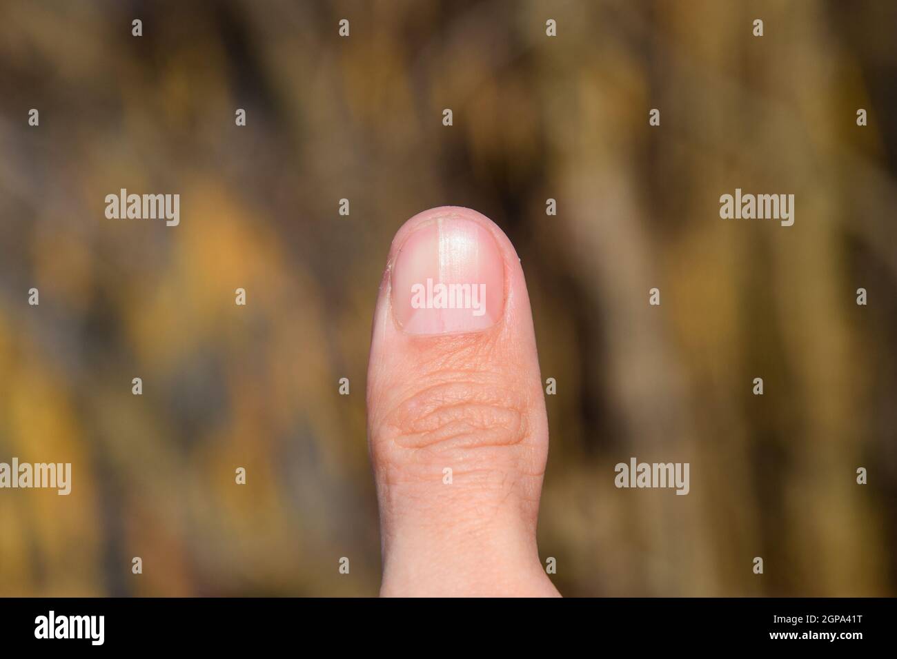 Forked nail on the thumb. Dilation of the nail, traumatic pathology ...