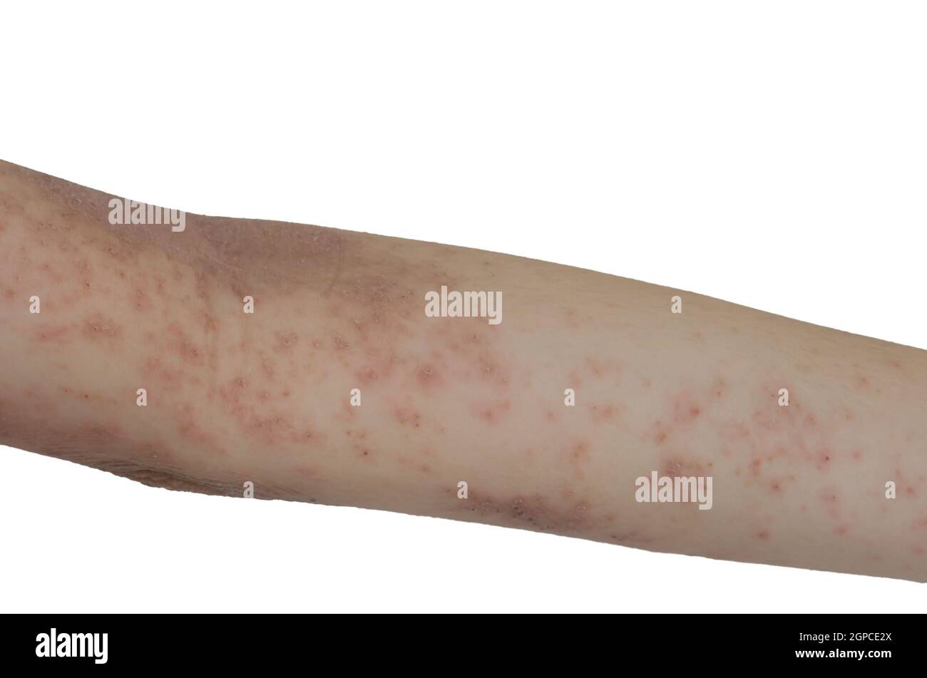 Heat rash hi-res stock photography and images - Alamy