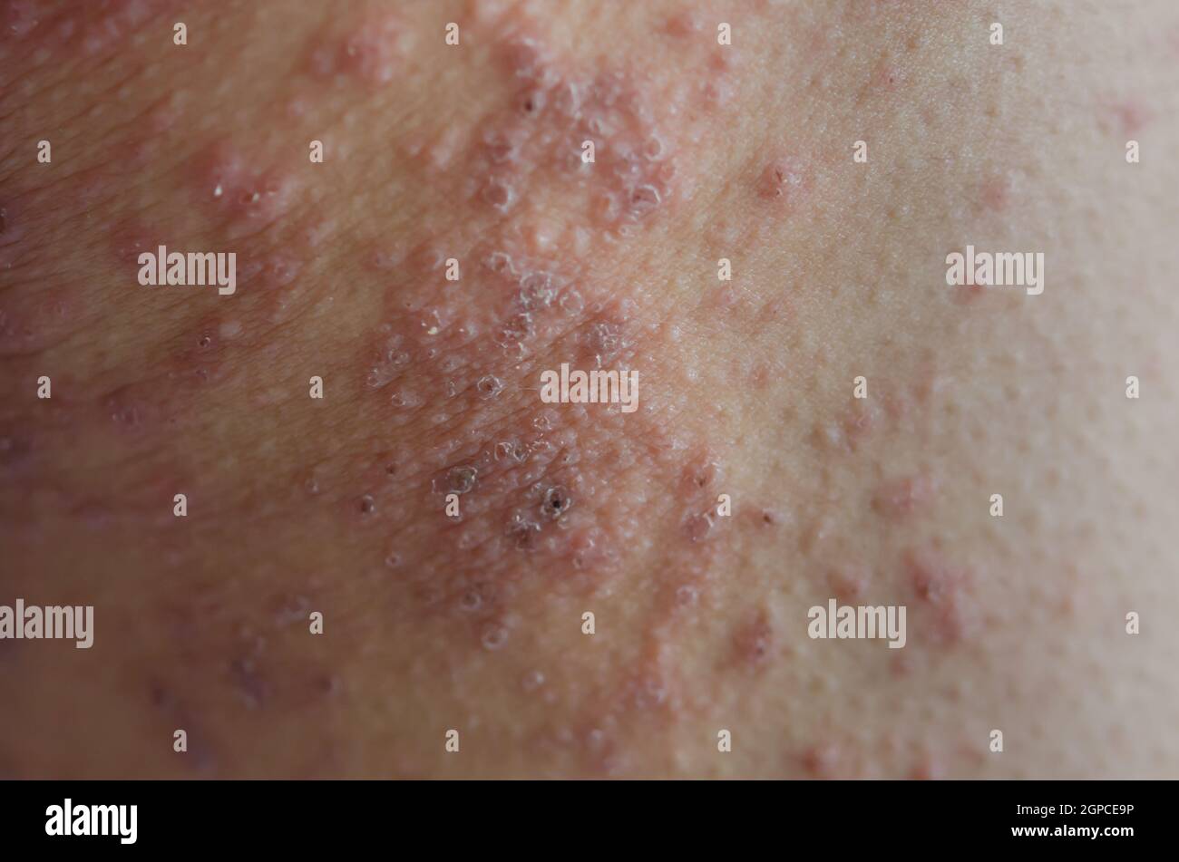 Close-up of skin rashes caused by allergies. Rashes are caused by food ...