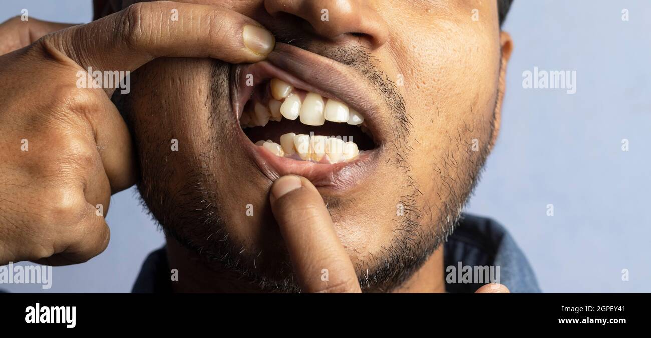 An Indian man showing extra irregular teeth Stock Photo - Alamy